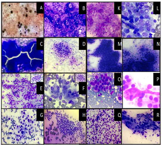 Thyroid cytology evaluation based on the Bethesda system with clinico ...