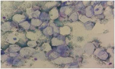 Epidermal Inclusion Cyst Cytology