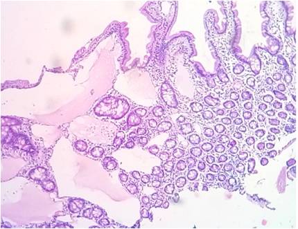 Evaluation of small intestinal biopsies in malabsorption syndromes ...