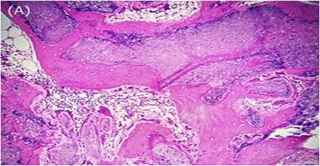 Pilomatrixoma with extensive ossification: a rare case report | Annals ...